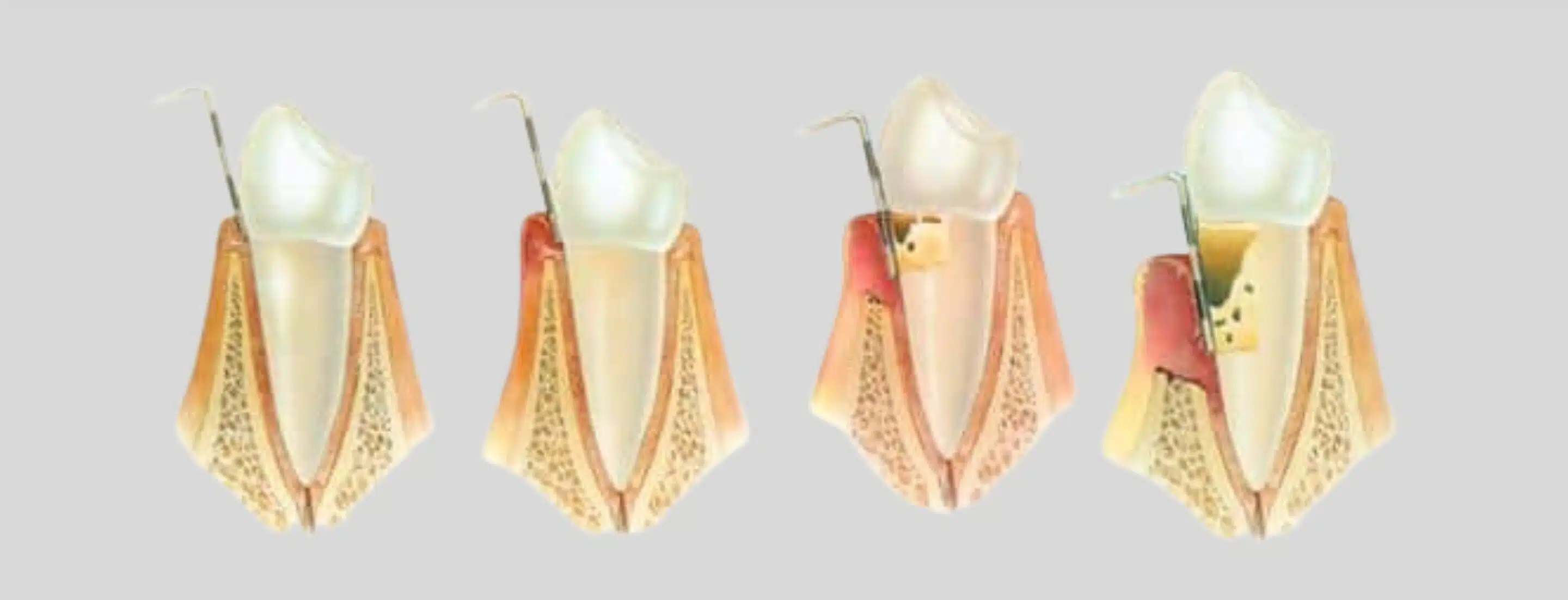 Clínica do Mar - Periodontite ou doença periodontal
