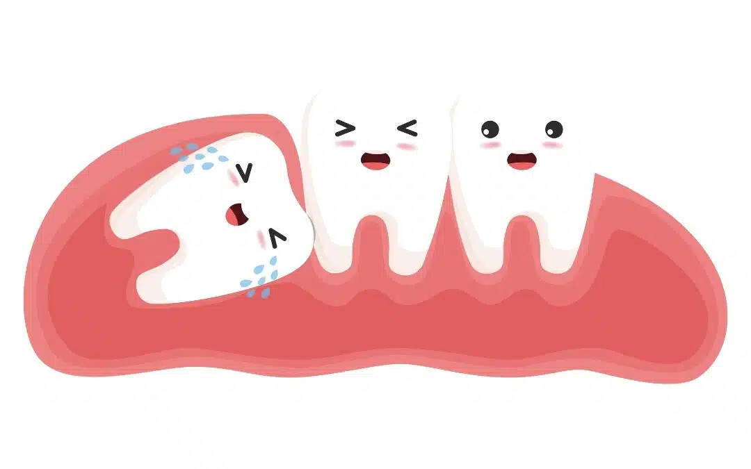 Dentes do siso: Tudo o que precisa de saber sobre eles!