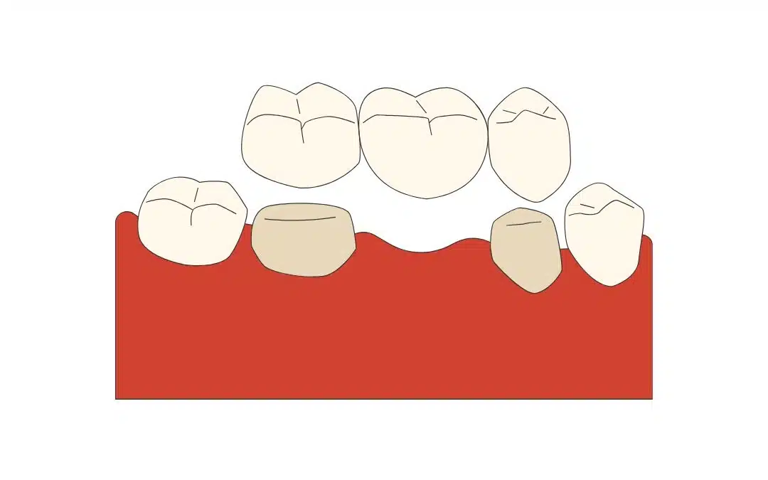 Já ouviu falar em Ponte Dentária? Saiba tudo aqui